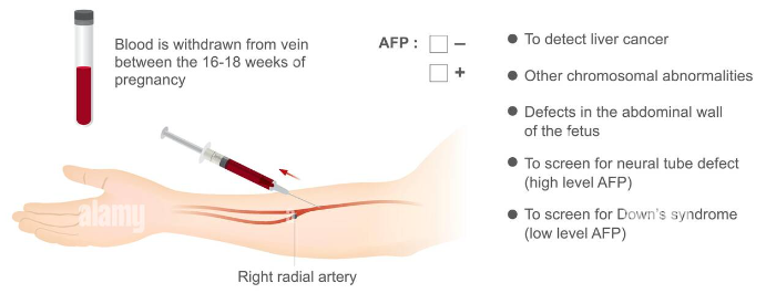 News - Do you know about Alpha-Fetoprotein Detection Project?