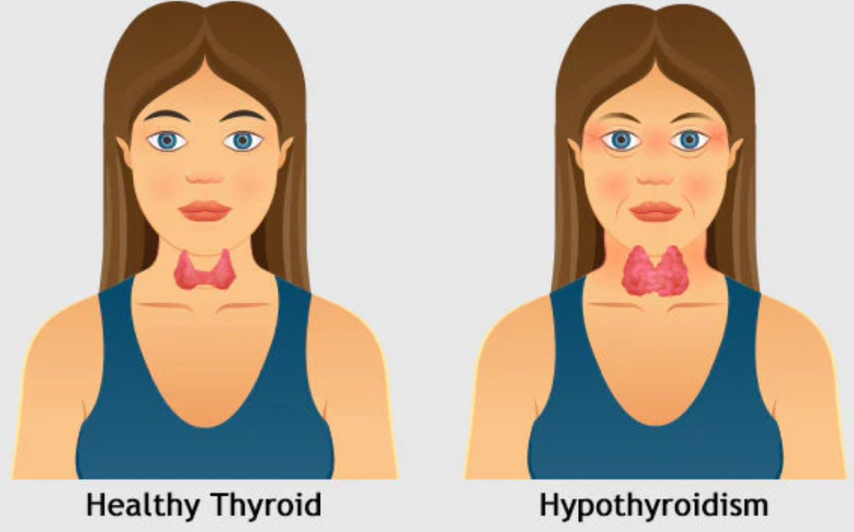 News - What is hypothyroidism disease